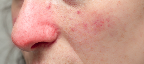 Why is my nose red? - Finca Skin Organics